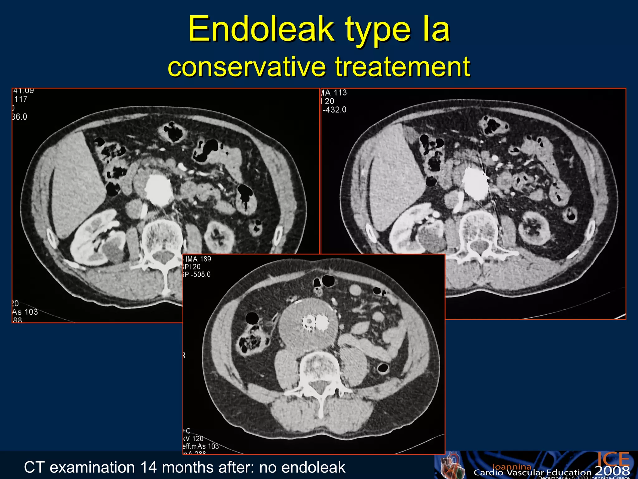 Endoleaks 1, 3 | PPT