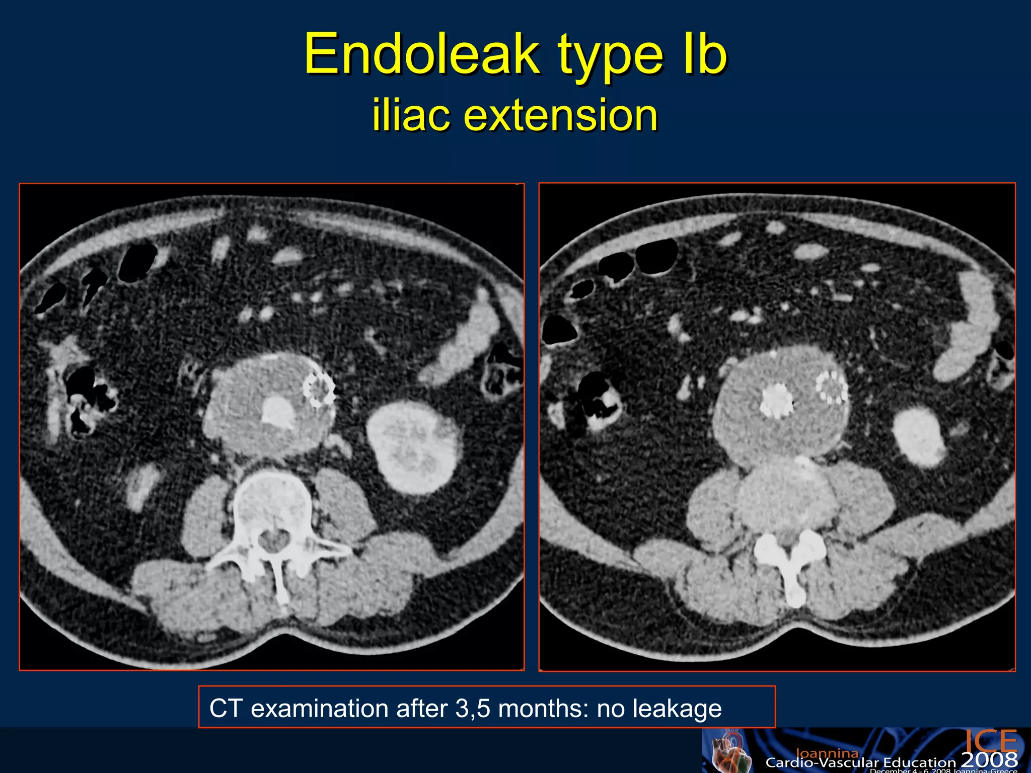 Endoleaks 1, 3 | PPT