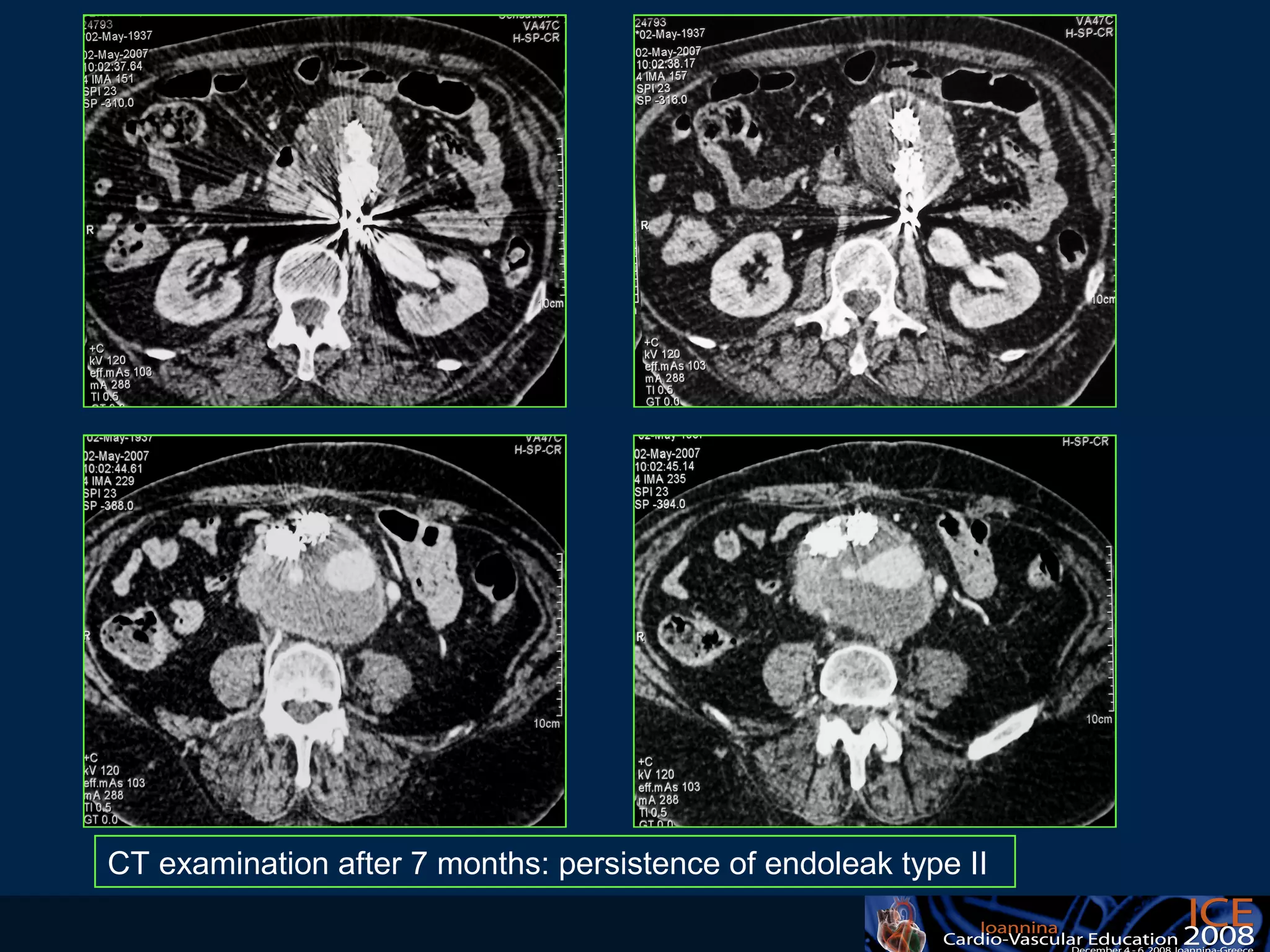 Endoleaks 1, 3 | PPT