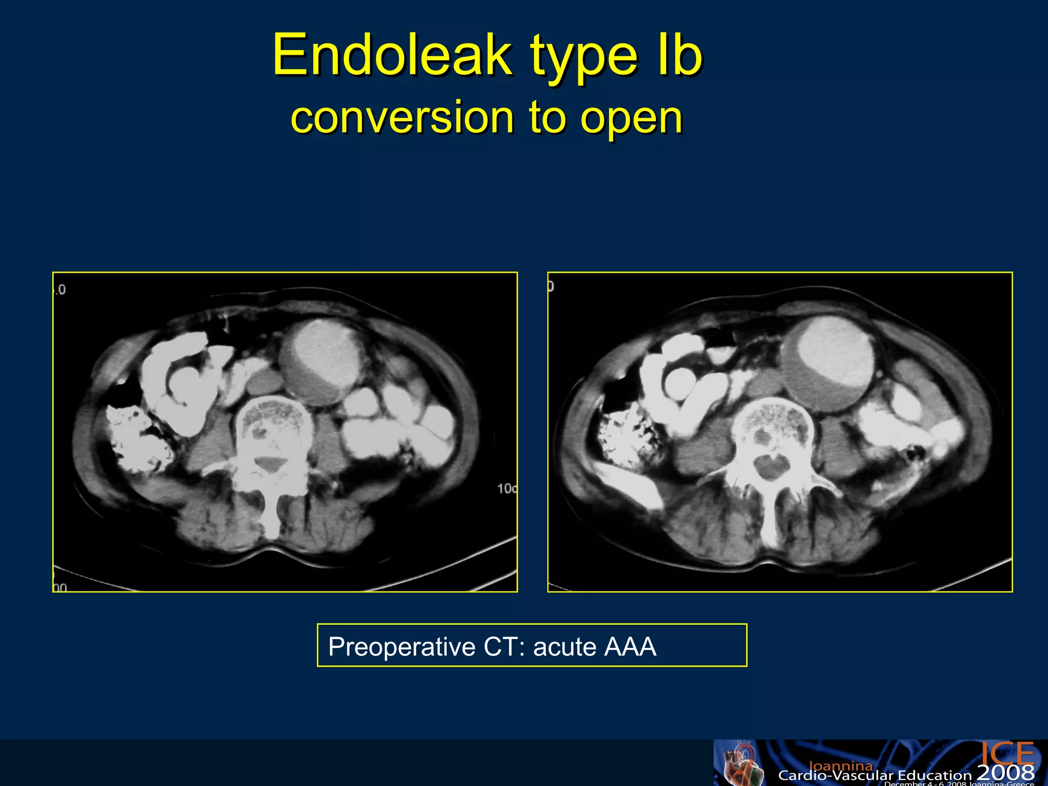 Endoleaks 1, 3 | PPT