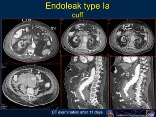 Endoleaks 1, 3 | PPT