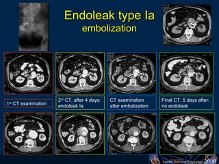 Endoleaks 1, 3 | PPT