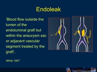 Endoleaks 1, 3 | PPT