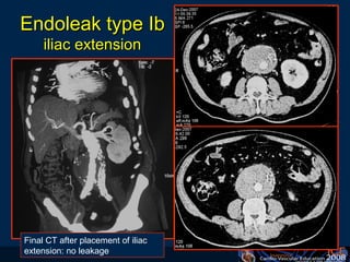 Endoleaks 1, 3 | PPT