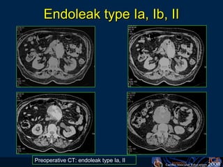 Endoleaks 1, 3 | PPT