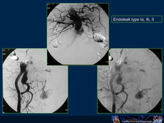 Endoleaks 1, 3 | PPT