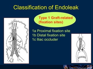 Endoleaks 1, 3 | PPT