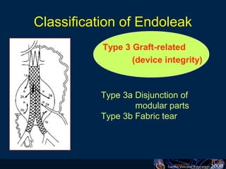 Endoleaks 1, 3 | PPT