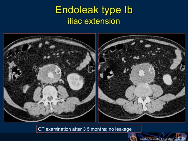 Endoleaks 1, 3