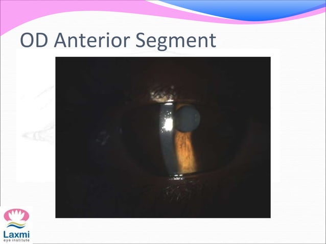 Ice syndrome | PPTX