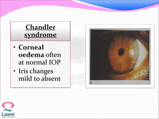 Chandlers Syndrome