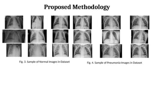 Detection and Classification of Pneumonia with Chest X-Ray Images using ...