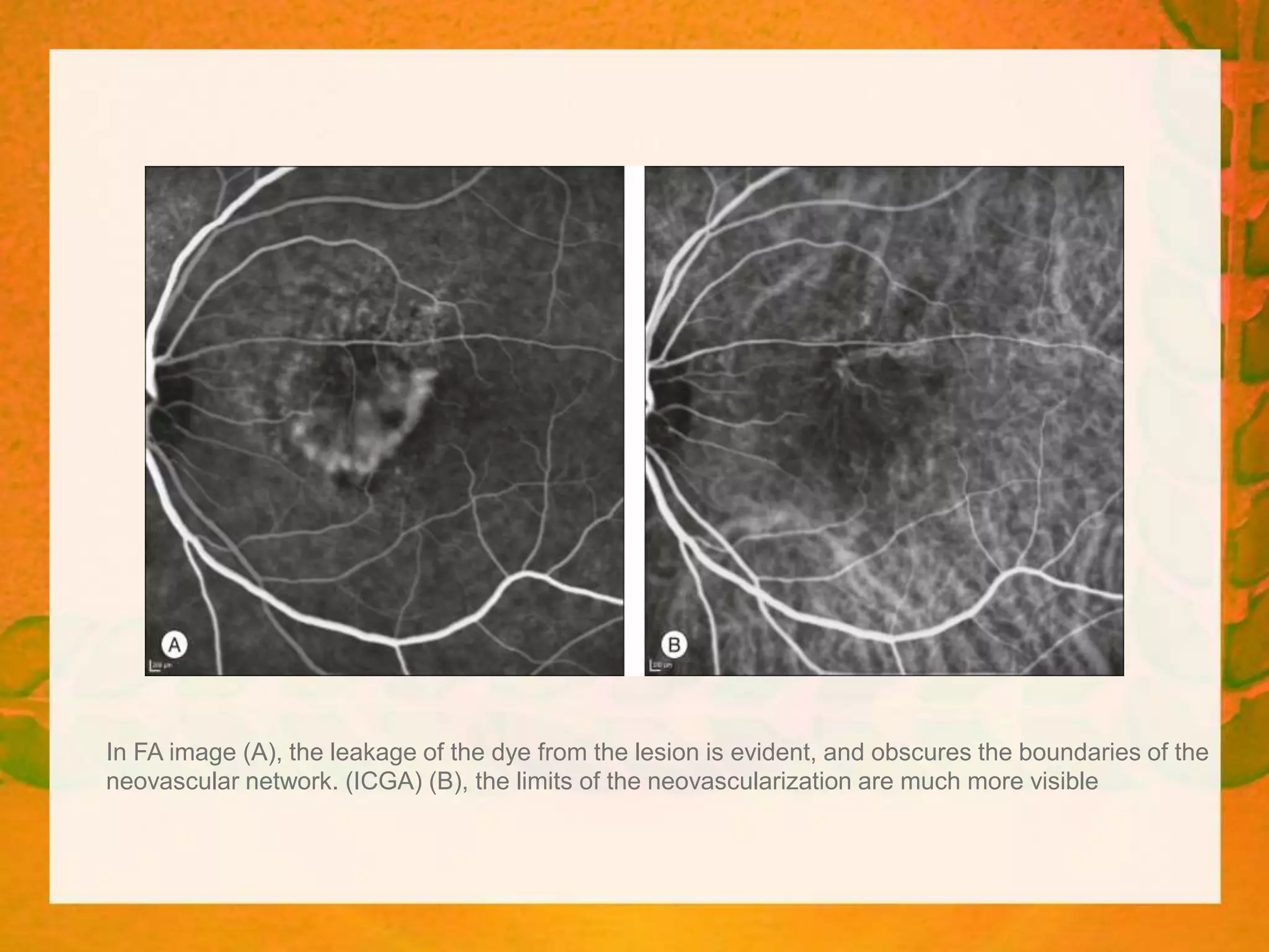 INDOCYANINE GREEN ANGIOGRAPHY | PPTX