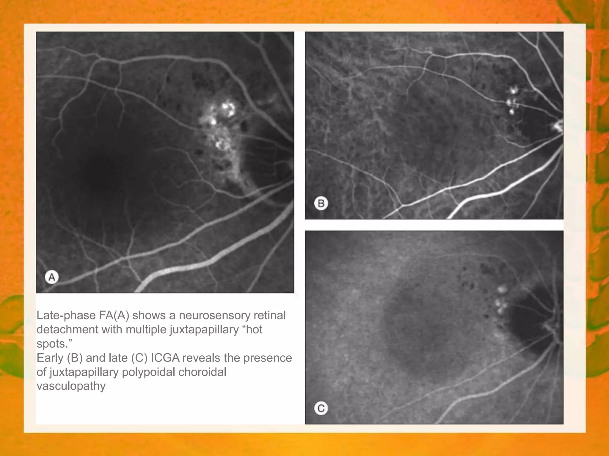 INDOCYANINE GREEN ANGIOGRAPHY | PPTX