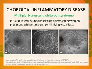 INDOCYANINE GREEN ANGIOGRAPHY | PPTX