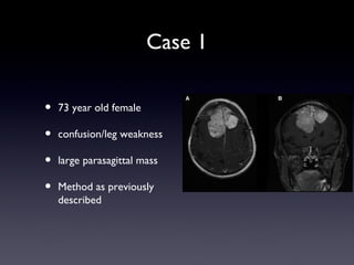 Icg and parasagittal lesions akil | PPT