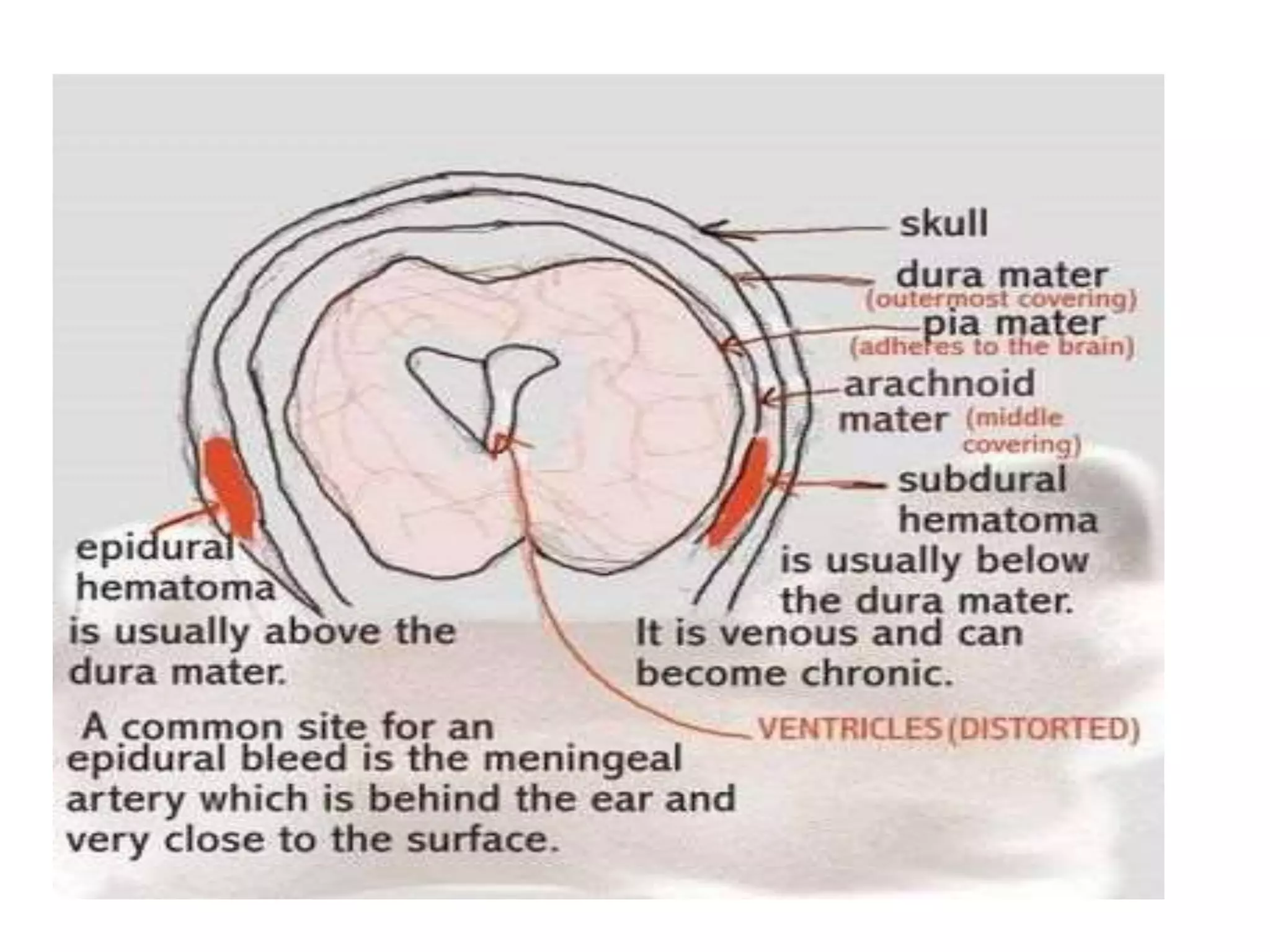 INTRA CRANIAL HEMATOMA.pptx