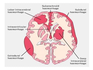INTRA CRANIAL HEMATOMA.pptx | First Aid | Injuries