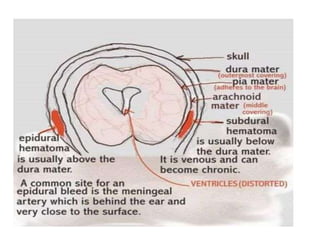 INTRA CRANIAL HEMATOMA.pptx