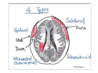 INTRA CRANIAL HEMATOMA.pptx