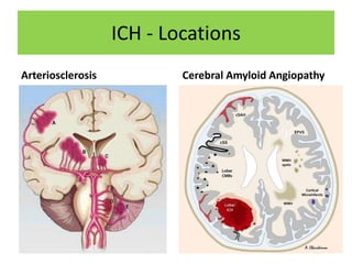 Evaluation and management of spontaneous Intracerebral hemorrhage | PPTX