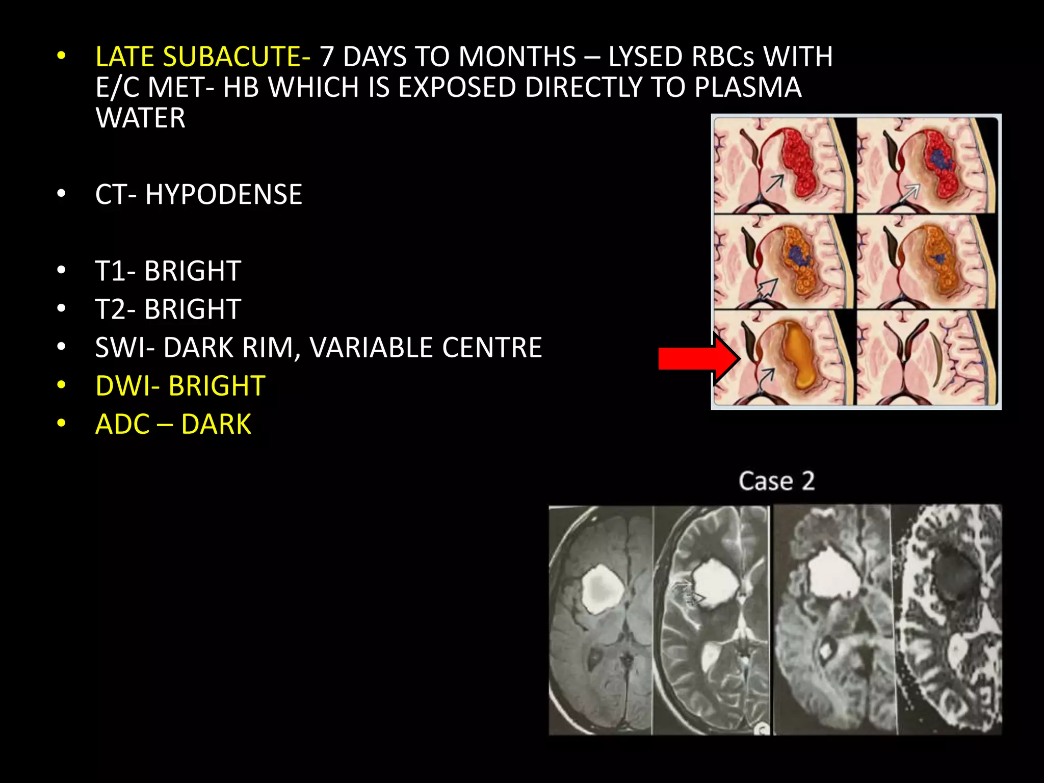INTRA CRANIAL HEMORRHAGE- AGING BLOOD ON MRI | PPTX