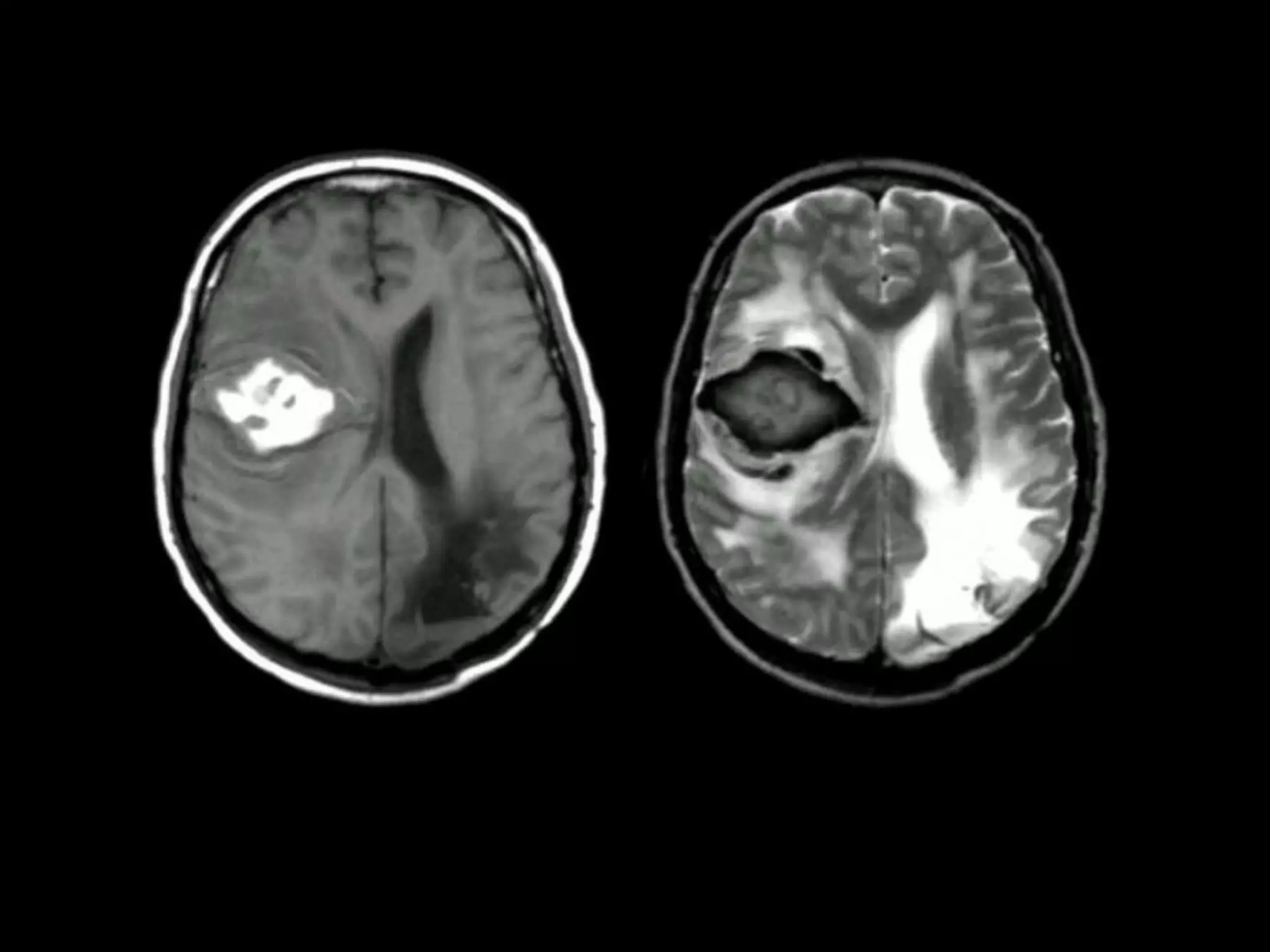 INTRA CRANIAL HEMORRHAGE- AGING BLOOD ON MRI | PPTX