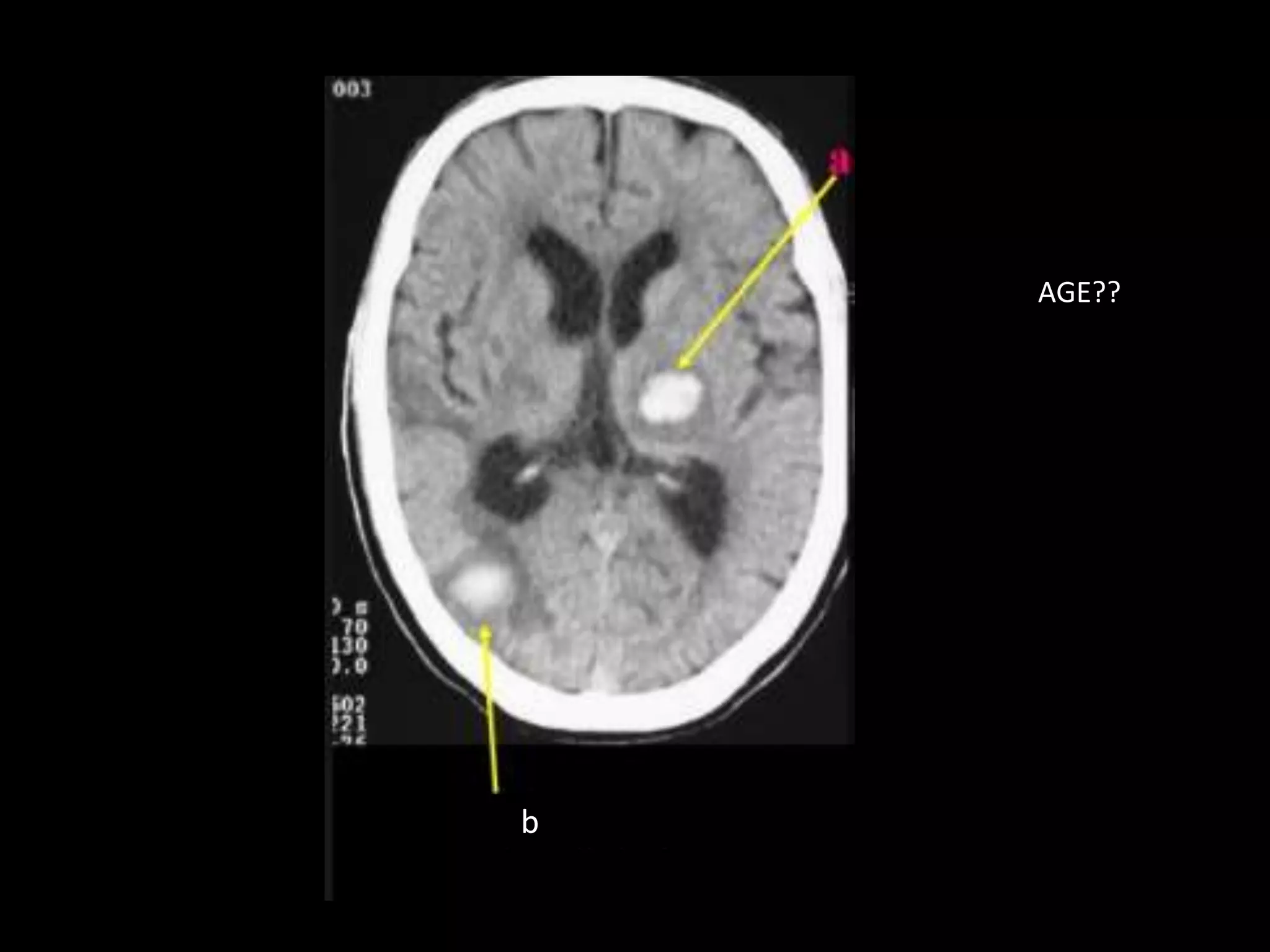 INTRA CRANIAL HEMORRHAGE- AGING BLOOD ON MRI | PPTX