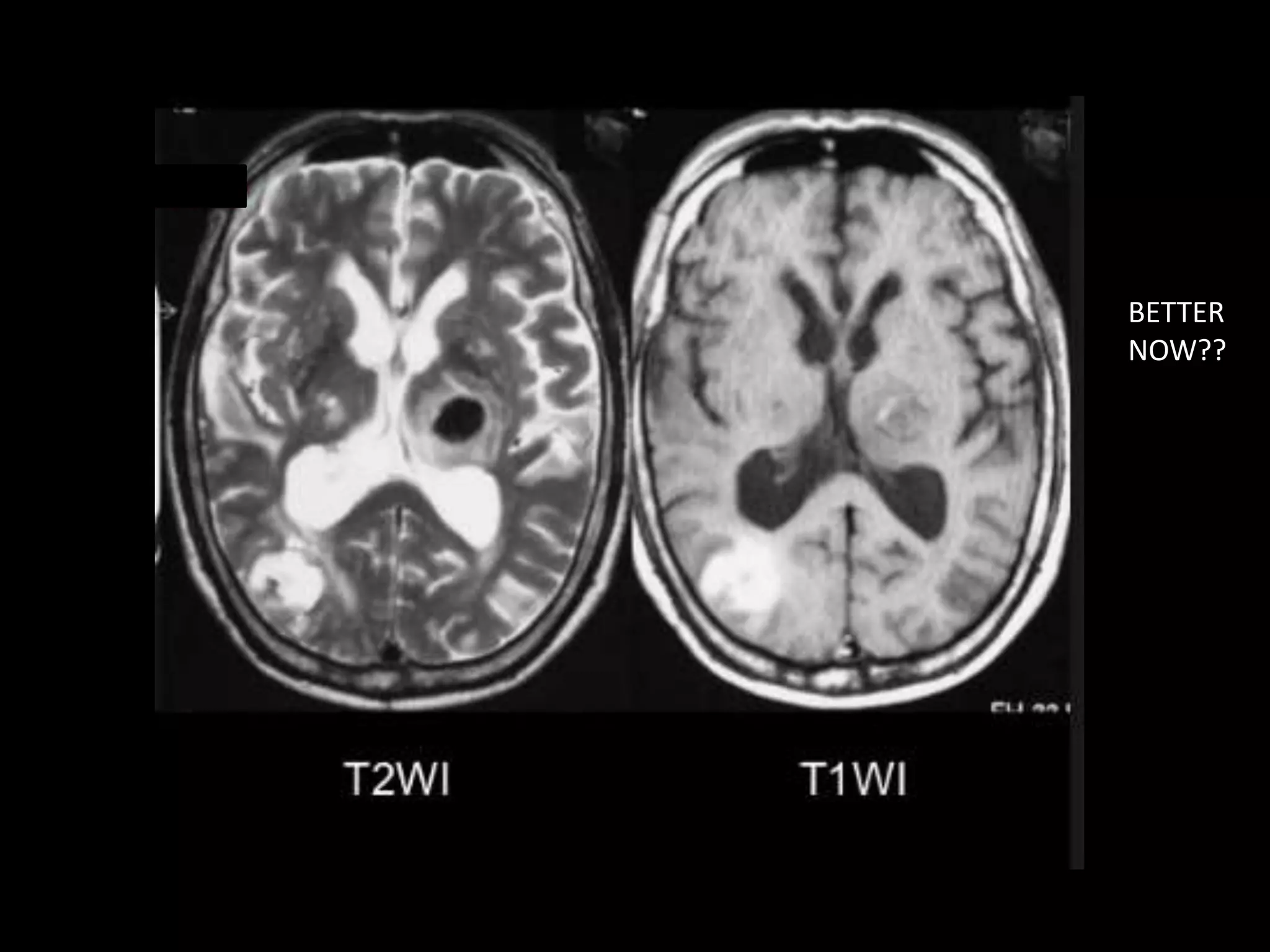 INTRA CRANIAL HEMORRHAGE- AGING BLOOD ON MRI | PPTX