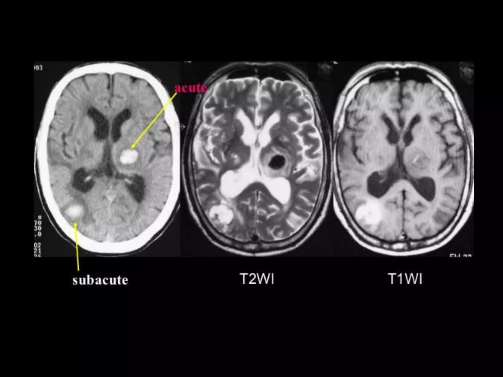 INTRA CRANIAL HEMORRHAGE- AGING BLOOD ON MRI | PPTX