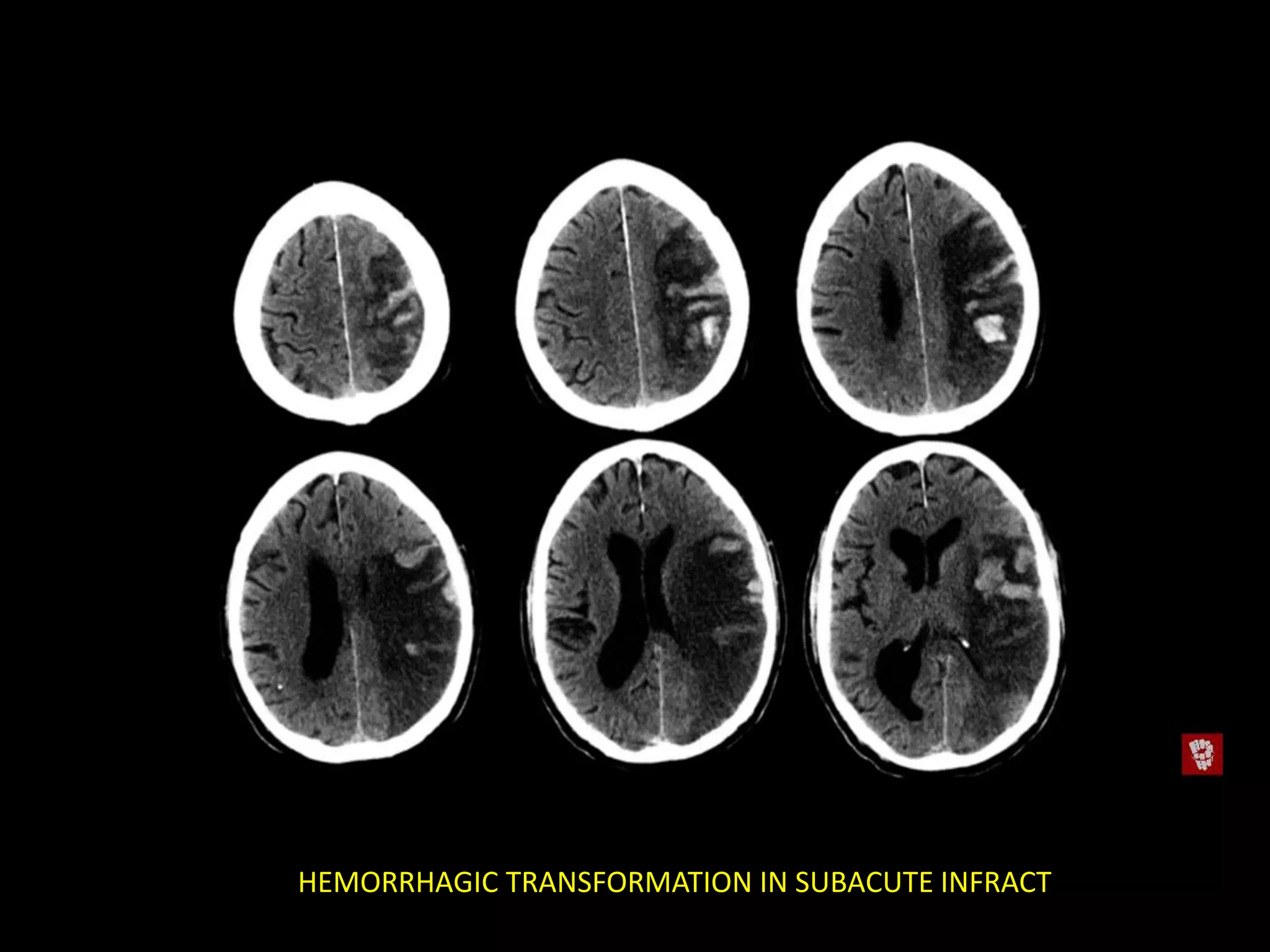 INTRA CRANIAL HEMORRHAGE- AGING BLOOD ON MRI | PPTX