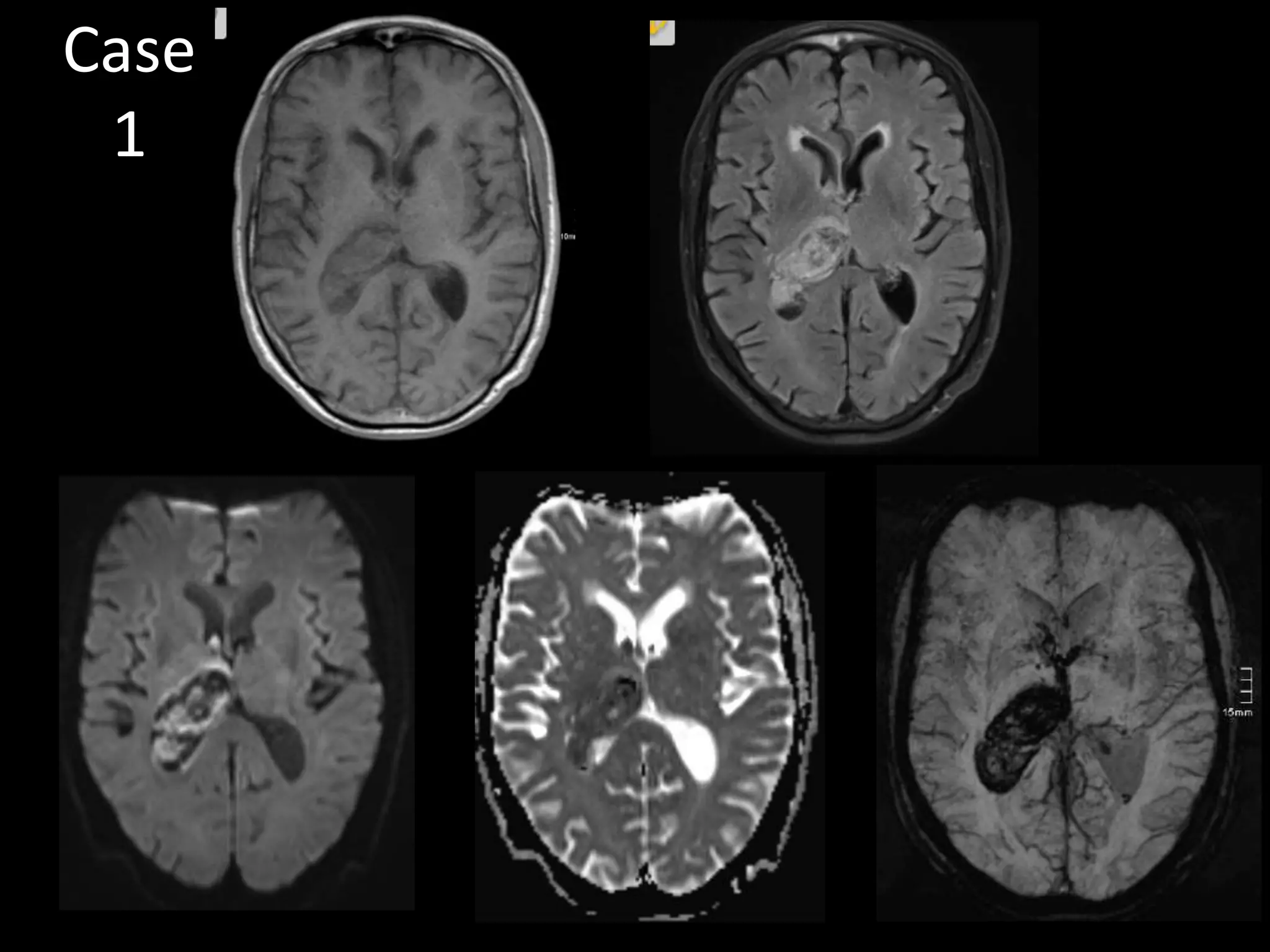 INTRA CRANIAL HEMORRHAGE- AGING BLOOD ON MRI | PPTX