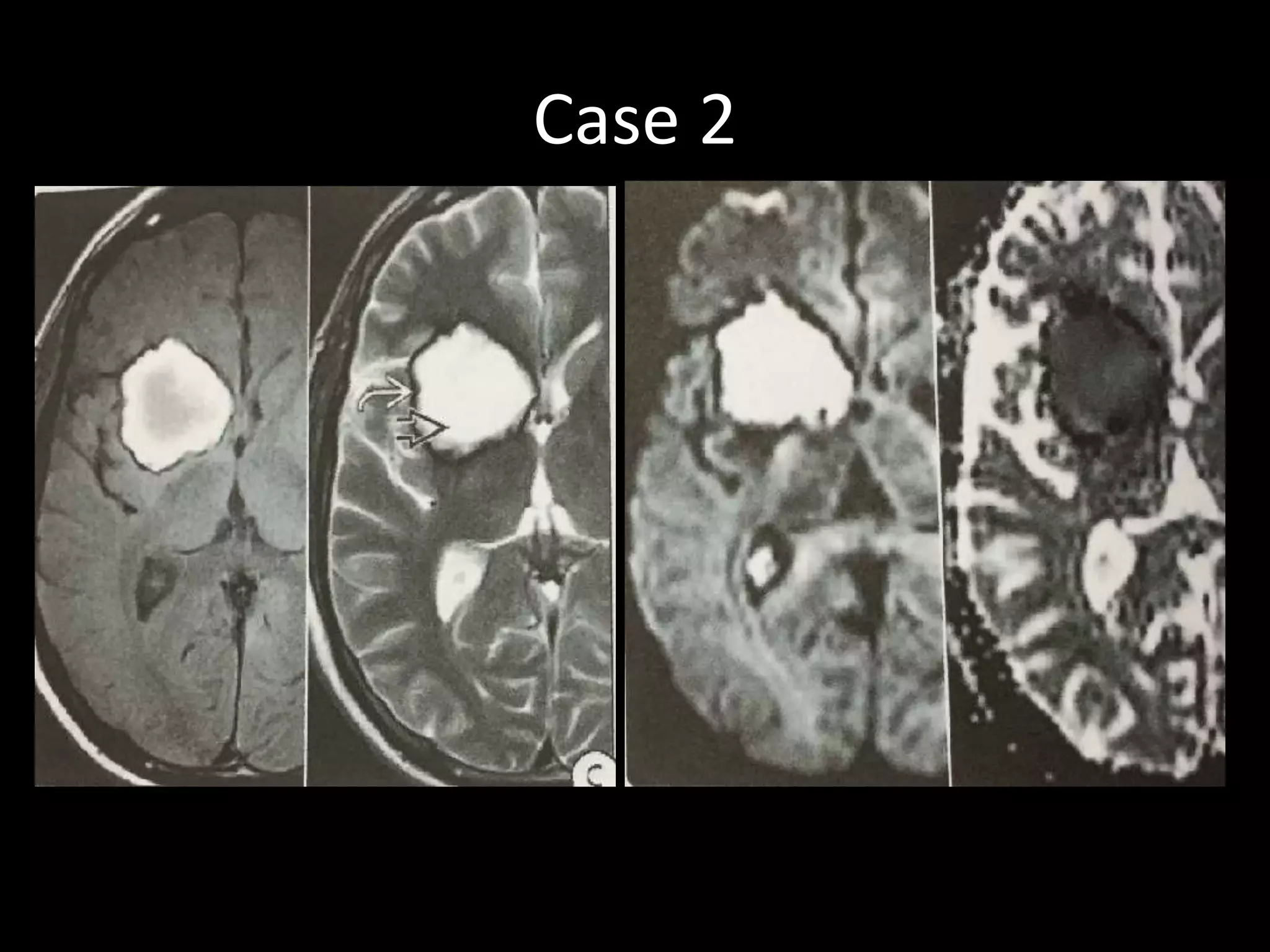 INTRA CRANIAL HEMORRHAGE- AGING BLOOD ON MRI | PPTX