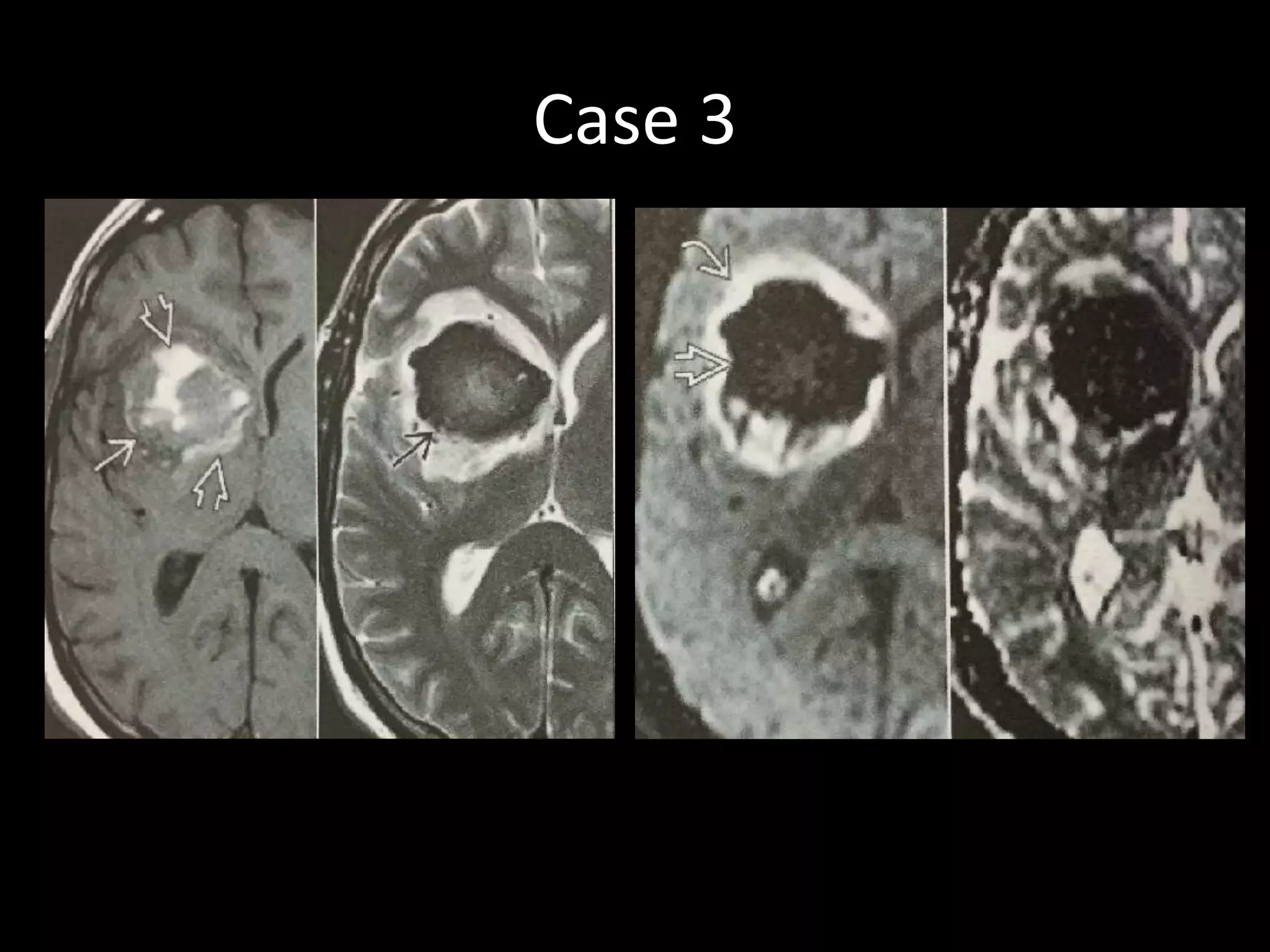 INTRA CRANIAL HEMORRHAGE- AGING BLOOD ON MRI | PPTX