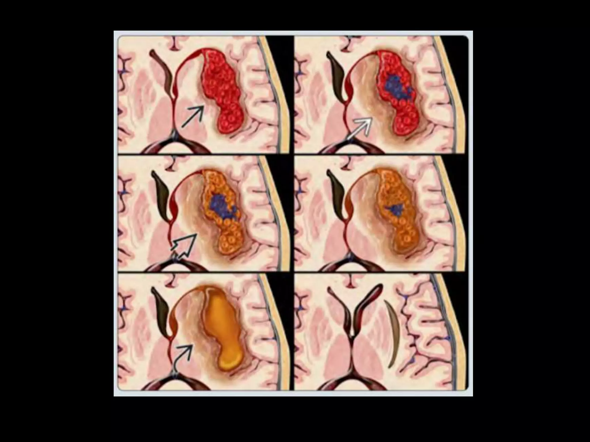 INTRA CRANIAL HEMORRHAGE- AGING BLOOD ON MRI | PPTX