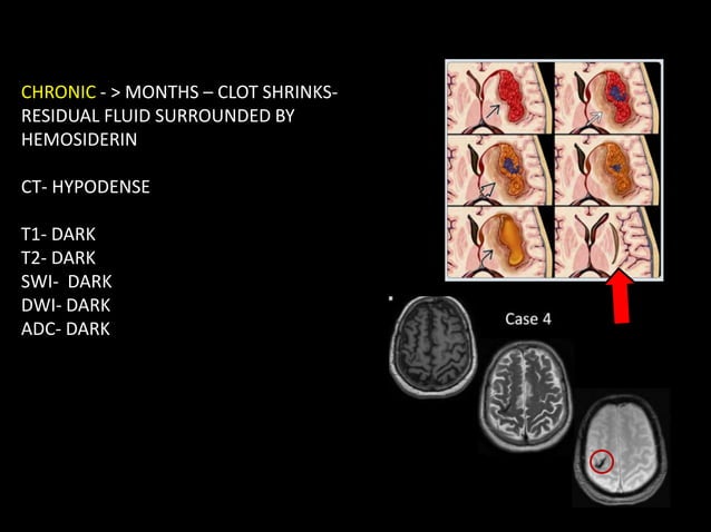 INTRA CRANIAL HEMORRHAGE- AGING BLOOD ON MRI | PPTX