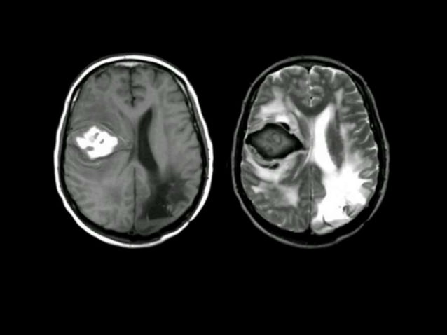INTRA CRANIAL HEMORRHAGE- AGING BLOOD ON MRI | PPTX