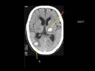 INTRA CRANIAL HEMORRHAGE- AGING BLOOD ON MRI | PPTX