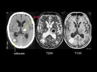 INTRA CRANIAL HEMORRHAGE- AGING BLOOD ON MRI | PPTX