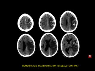 INTRA CRANIAL HEMORRHAGE- AGING BLOOD ON MRI | PPTX