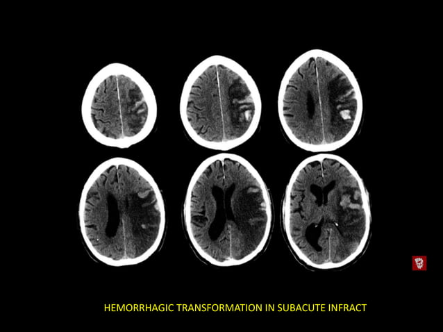 INTRA CRANIAL HEMORRHAGE- AGING BLOOD ON MRI | PPTX