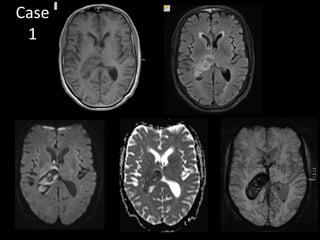 INTRA CRANIAL HEMORRHAGE- AGING BLOOD ON MRI | PPTX