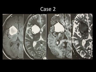 INTRA CRANIAL HEMORRHAGE- AGING BLOOD ON MRI | PPTX