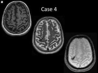 INTRA CRANIAL HEMORRHAGE- AGING BLOOD ON MRI | PPTX
