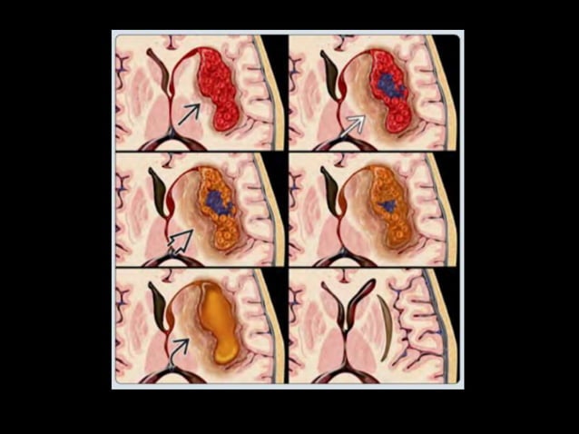 INTRA CRANIAL HEMORRHAGE- AGING BLOOD ON MRI | PPTX