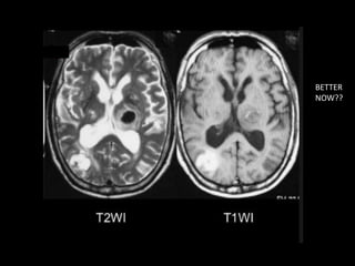 INTRA CRANIAL HEMORRHAGE- AGING BLOOD ON MRI | PPT