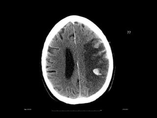 INTRA CRANIAL HEMORRHAGE- AGING BLOOD ON MRI | PPT