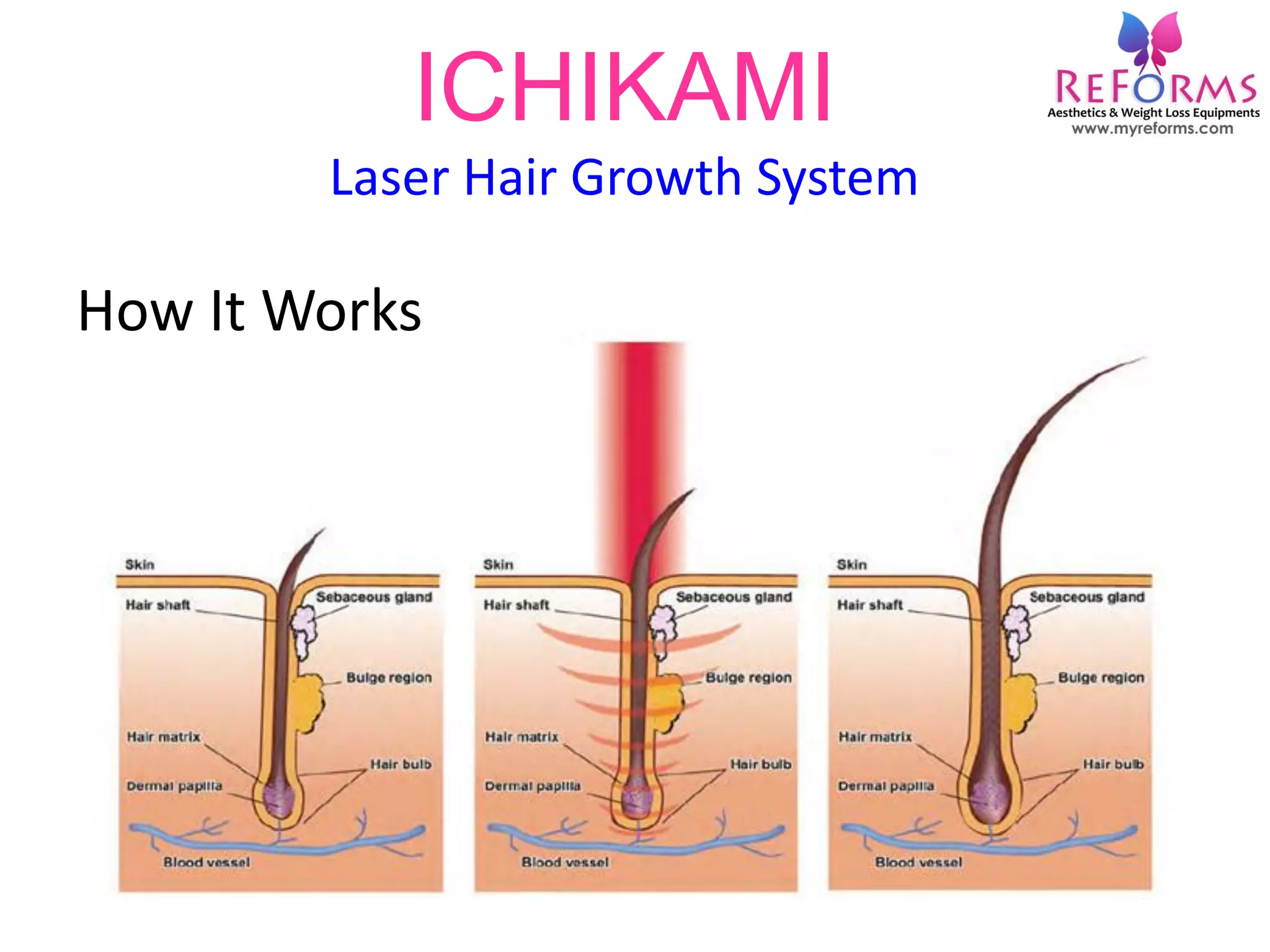 Ichikami Laser Regrowth System | PDF