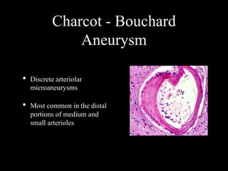 Intracerebral hemorhage Diagnosis and management | PPTX