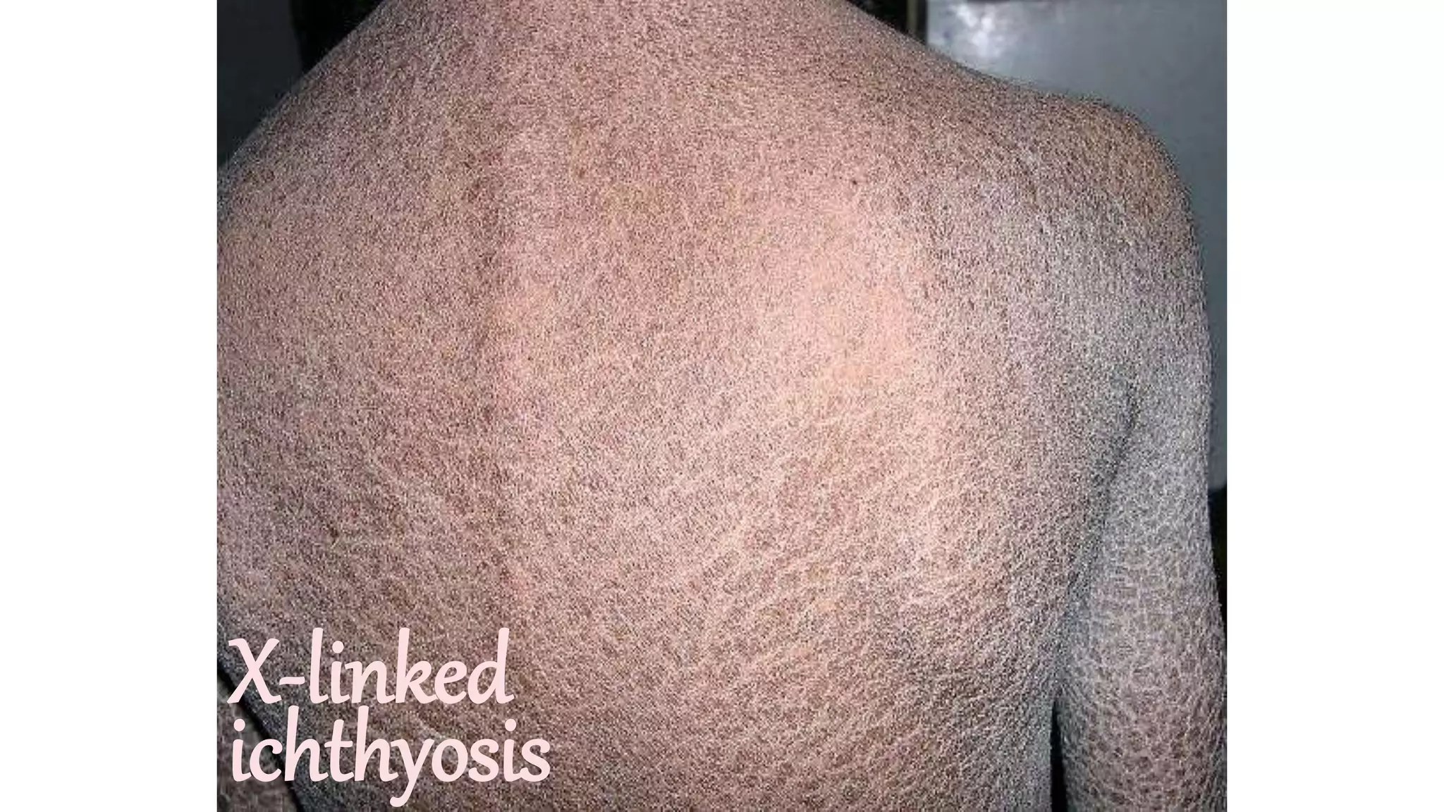 Ichthyoses | PPTX